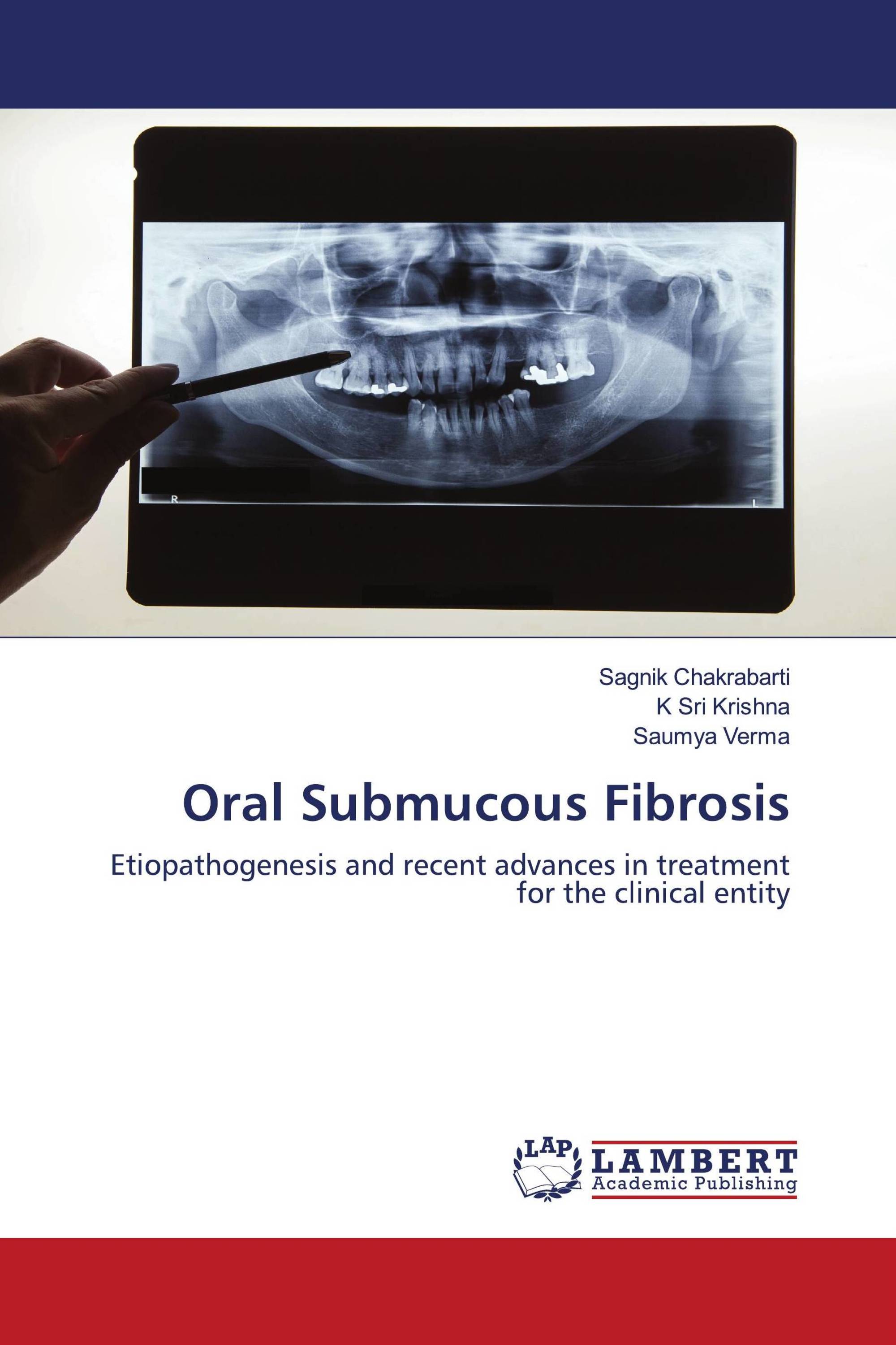 Oral Submucous Fibrosis / 978-620-3-86353-6 / 9786203863536 / 620386353X