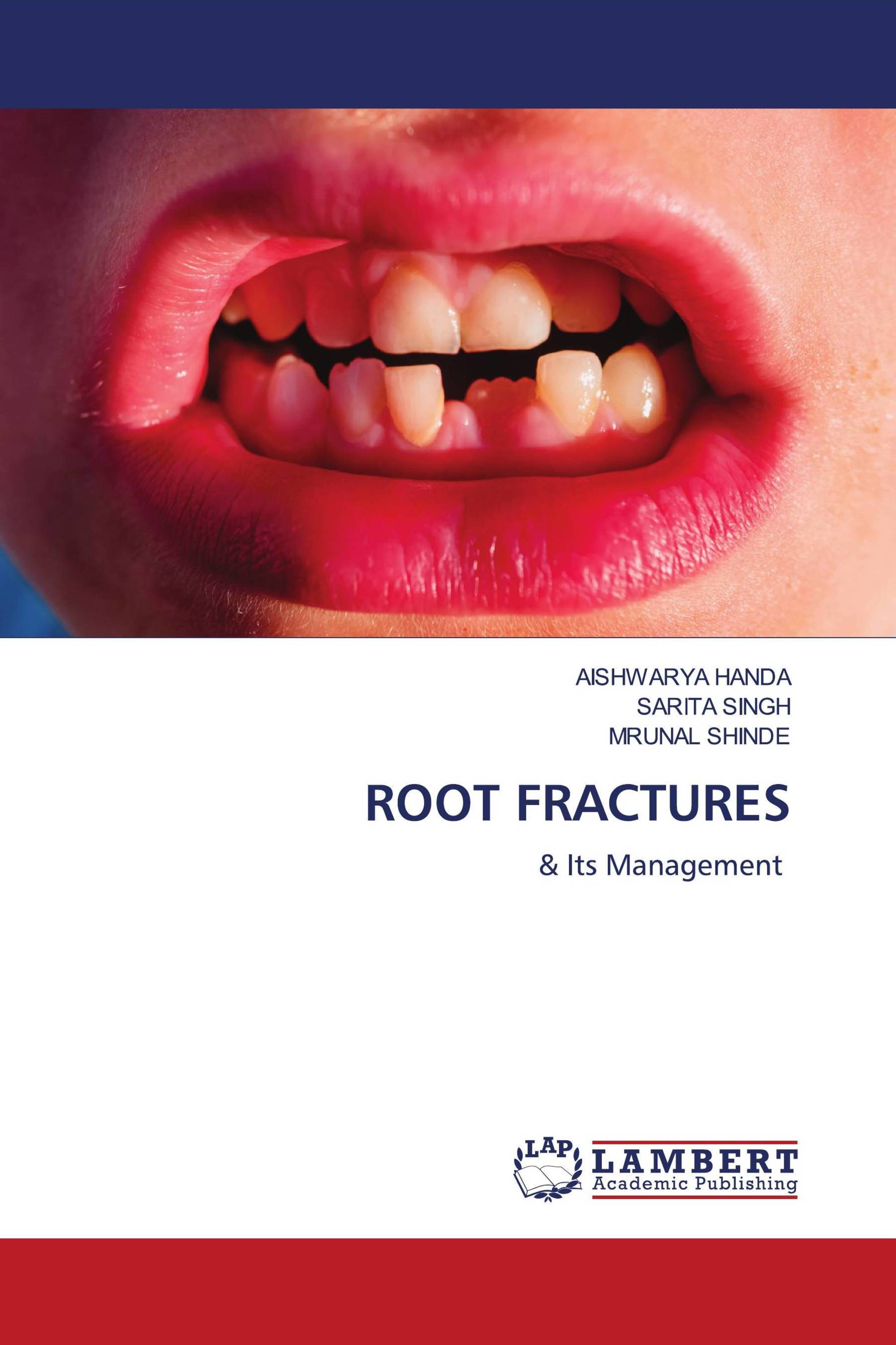 ROOT FRACTURES / 978-620-3-92326-1 / 9786203923261 / 6203923265