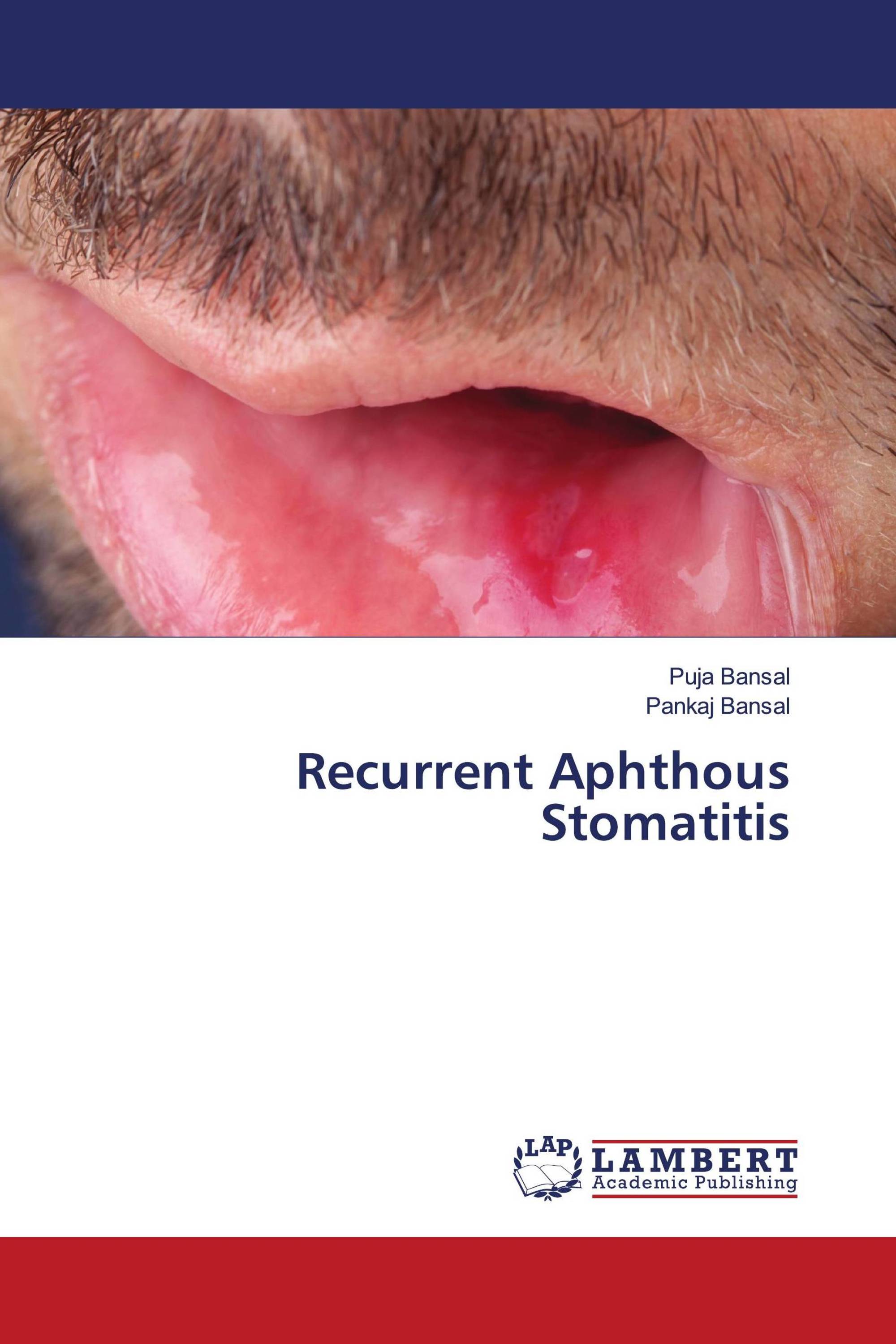 Stomatitis Aphthous Oral Ulceration: Causes And Management The