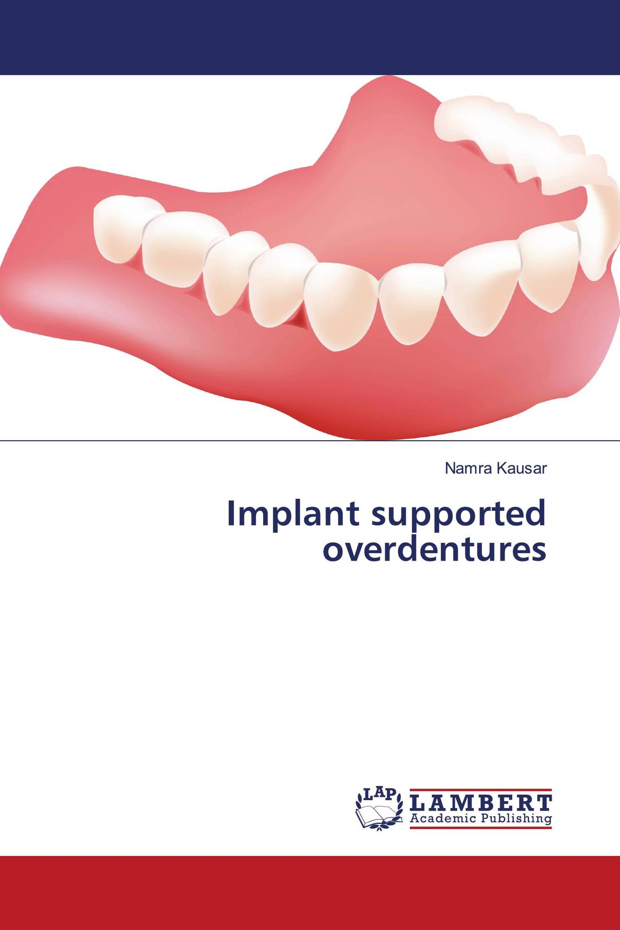 Implant supported overdentures / 978-620-6-18299-3 / 9786206182993 ...